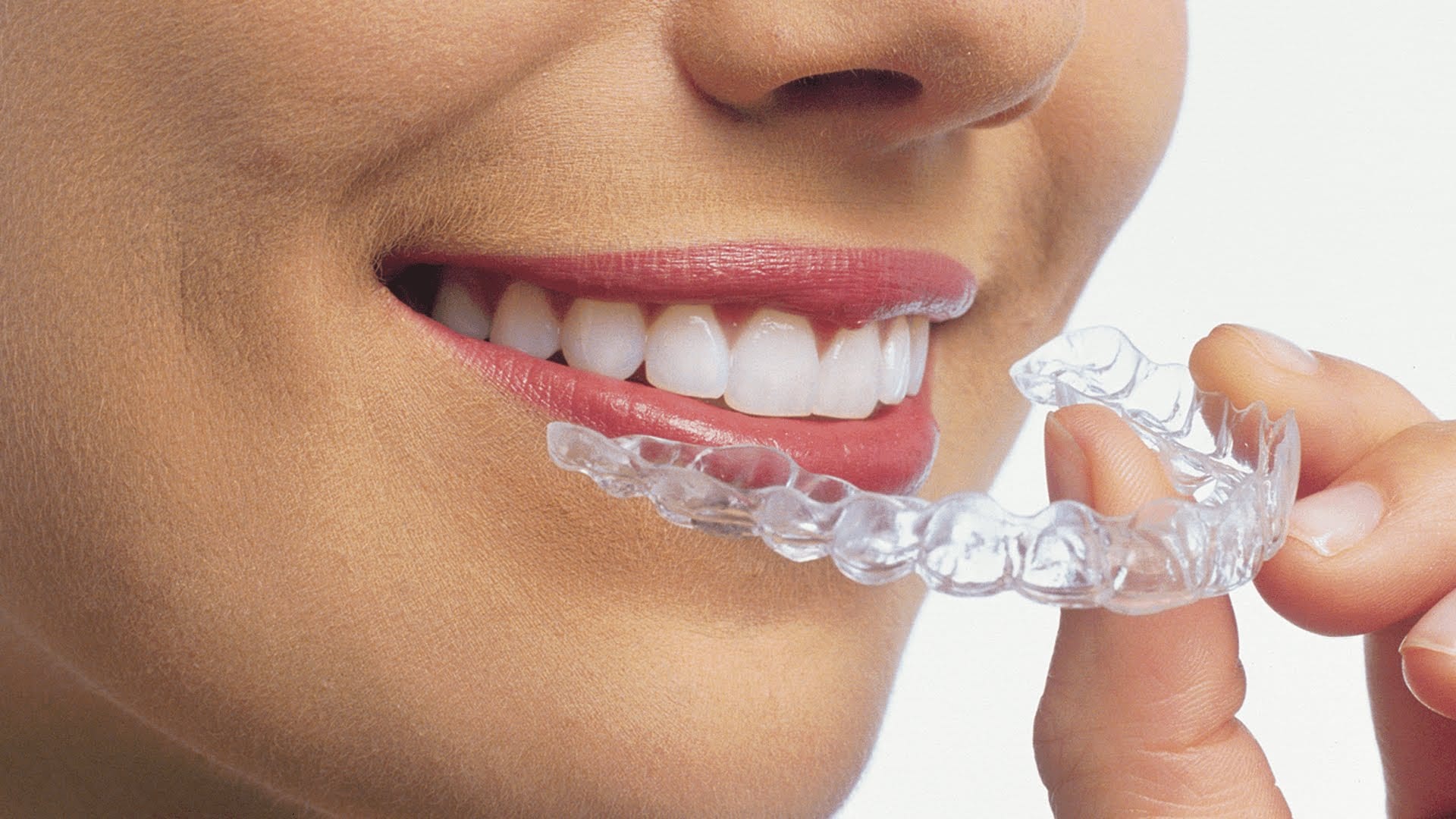 The pros of invisible braces | Sabrina 'Princessa' Wang